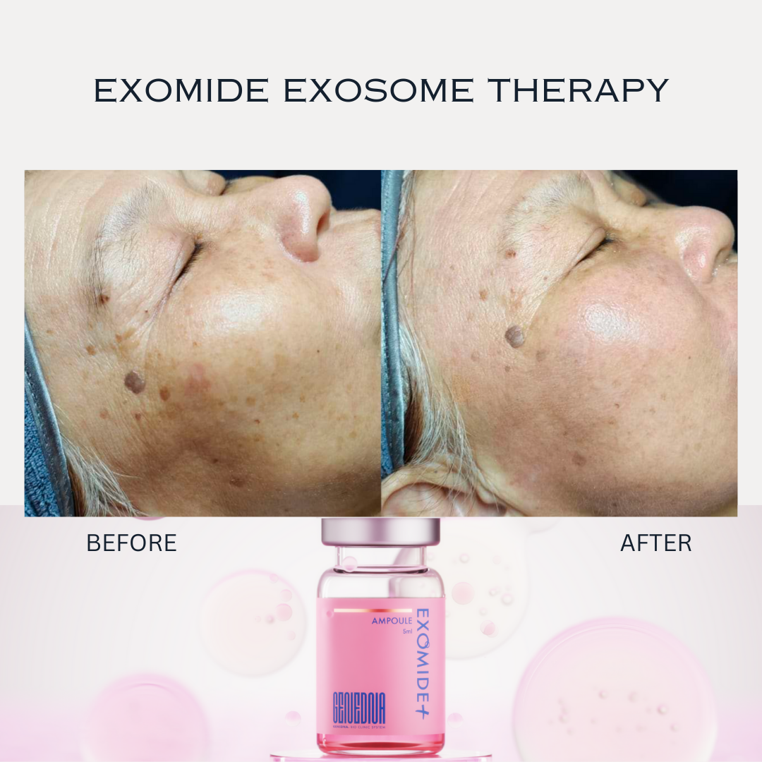 Exomide Skin Therapy - Celluderm