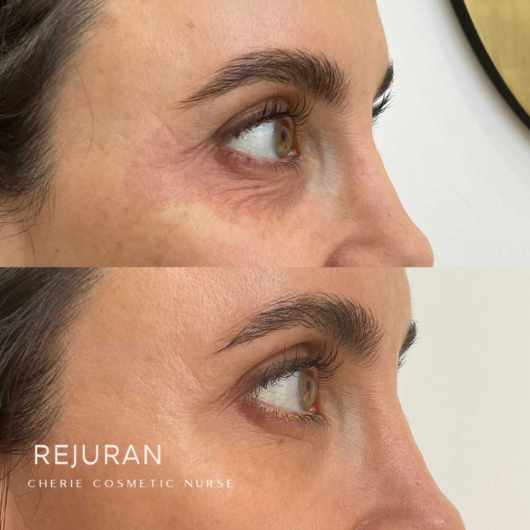 REJURAN®-I Skin Booster for the eye area - Celluderm