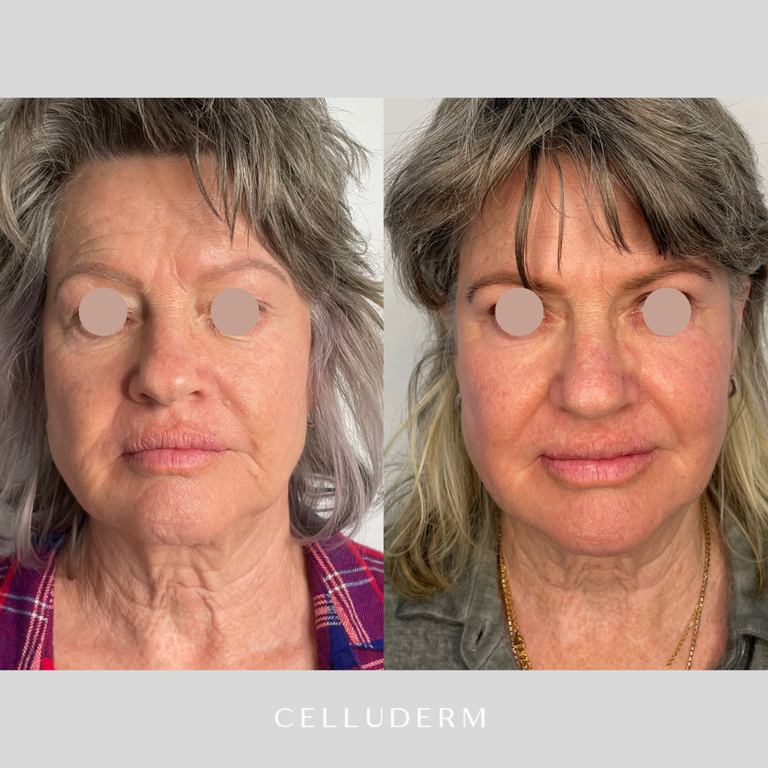 Skin Bio-Remodelling Treatment - Celluderm